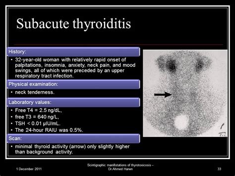 Thyrotoxicosis In Thyroid Scan Youtube