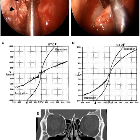 Intraoperative Findings Ab The Submucosal Tissue With Severe Download Scientific Diagram