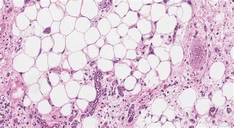 Dedifferentiated Liposarcoma Ottawa Atlas Of Pathology
