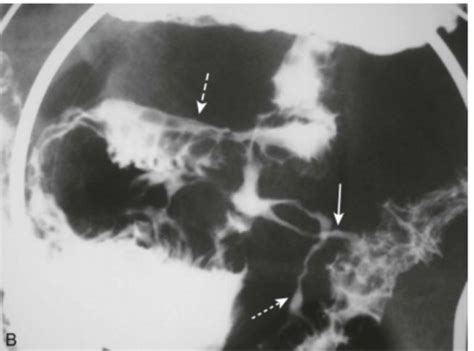 Mdandp Ii Exam 2 Recognizing Radiologic Abdominal And Pelvic Abnormalities Flashcards Quizlet