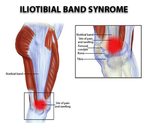 Iliotibial Band Pain Relief Iliotibial It Band Syndrome Stretches