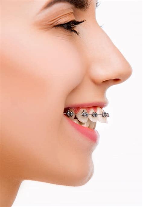 How Do Interceptive Orthodontics Help Your Oral Health