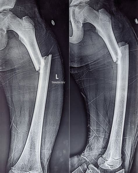 X Rays Of Broken Femur