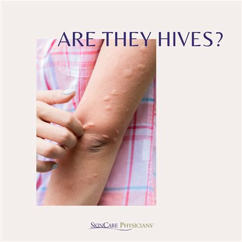 How To Know If Hives Are Going Away
