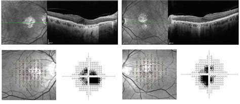 What Macular Degeneration To Geographic Atrophy Progression Really