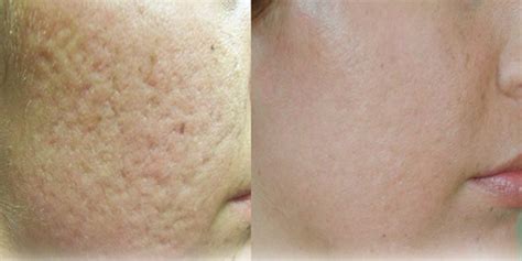 How To Remove Open Pores Ask Kfoods