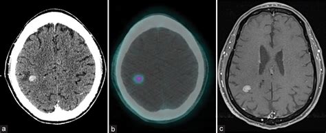 Intracranial Metastasis From Prostate Cancer Investigation Incidence
