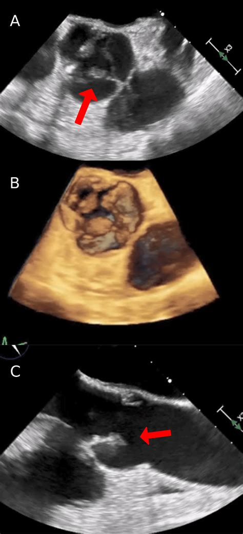 Rare Case Of Marantic Endocarditis In Metastatic Lung Adenocarcinoma