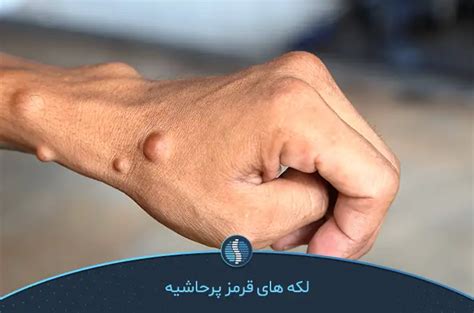 لکه های قرمز روی پوست با خارش؛ هوای زیبایی‌تان را داشته باشید