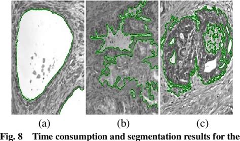 figure 8 from automatic segmentation of colon cancer cells based on