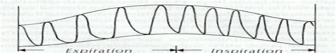 Cardio Ap Assessment Ekg Pacemaker Flashcards Quizlet