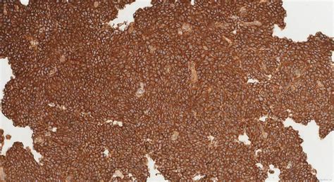 Ewings Sarcoma Ottawa Atlas Of Pathology