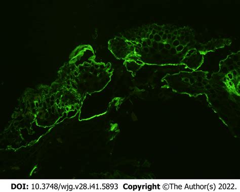 Direct Immunofluorescence Fibrinogen Deposits In The Basal Membrane As