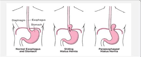 Hiatal Hernia Diaphragm Spasm At Alan Matheny Blog