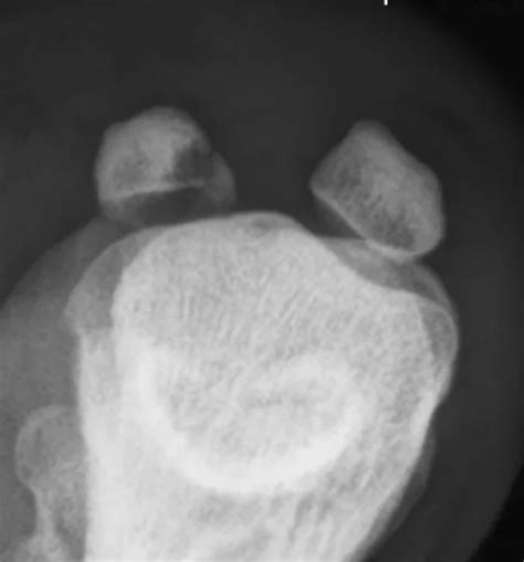 Sesamoid R Radiology