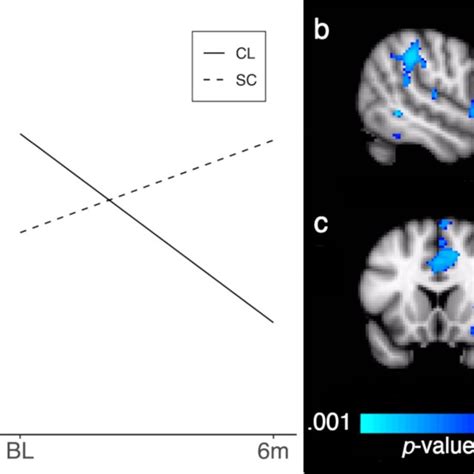 longitudinal differences in whole brain gray matter between