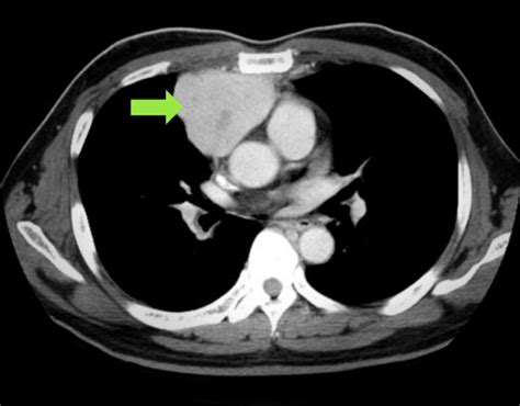 Mediastinal Tumor Mass Symptoms Diagnosis And Stages Saint Johns