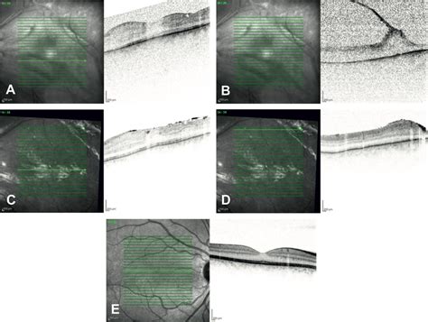 SD OCT Images Of The Left Eye Before And After The Cataract Surgery A Download Scientific