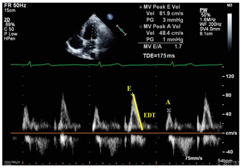 Left Ventricular Diastolic Left Ventricular Dimensions Yjnkg
