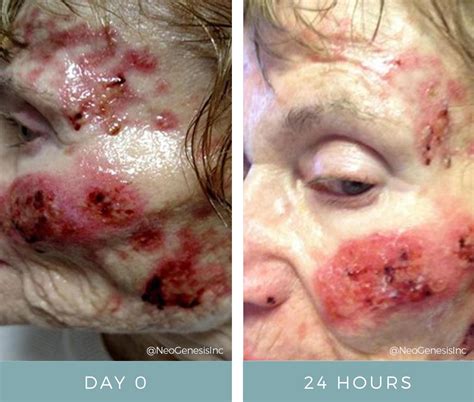 Topical Chemotherapy Side Effects Before After Photos