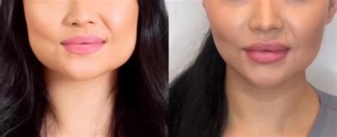 Why You Should Consider Masseter Muscle Botox 5 Benefits With Skin