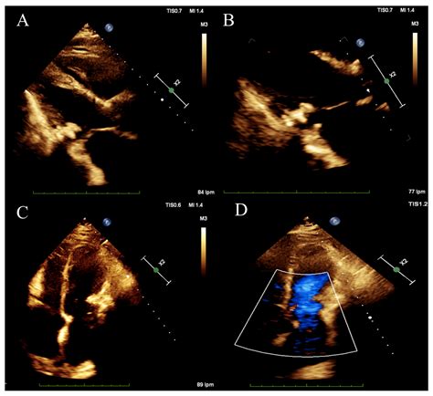 Pericardial Calcification An Uncommon Case With Intraventricular Extension