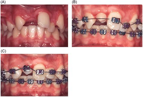 Alternatives To Root Canal Treatment Tooth Autotransplantation Pocket Dentistry