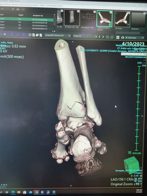 I Broke My Tibia In 2 Places Today On My Ankle Side And The Back R Brokenbones