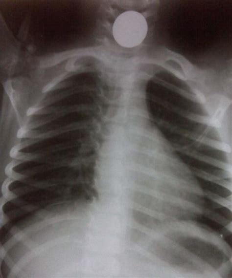 Icd 10 Cm New Foreign Body External Cause Codes