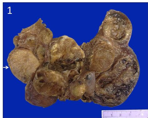 Gross Pathology Of The Thyroid Gland Cut Surface Shows Diffuse