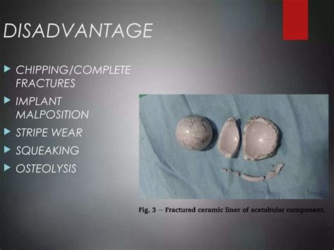 Total Hip Replacement And Types Of Prosthesis Ppt