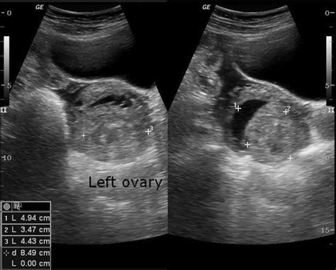 Hemorrhagic Corpus Luteum Ultrasound