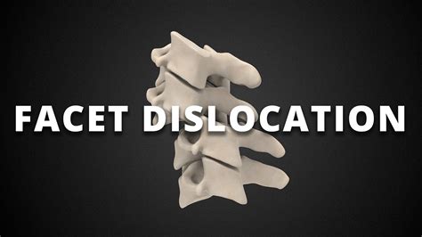 Facet Dislocation Unilateral Subluxation Perched And Locked Facets Youtube