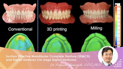 Suction Effective Mandibular Complete Denture Semcd And Digital