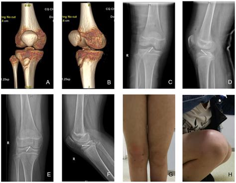 A Typical Case Ab A 12 Year Old Female Patient Was Diagnosed As