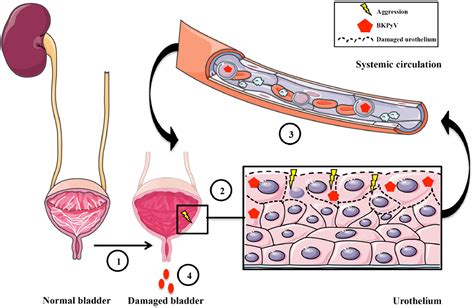 Bk Virus Infection In Allogeneic Hematopoietic Cell Transplantation An Update On Pathogenesis