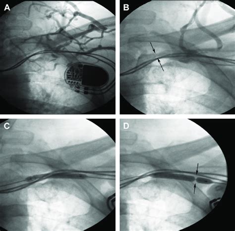 Crossing A Subclavian Occlusion And Performing Venoplasty A The