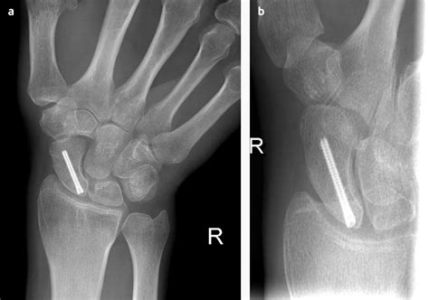 Scaphoid Fracture Symptoms Numbness At Katie Eliott Blog