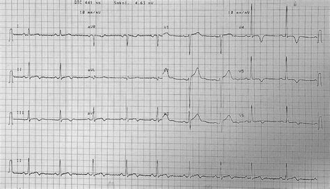 Inferolateral T Wave Inversion In Athletes A Phenotype Genotype Correlation Heart