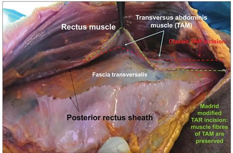 Transversus Abdominis Muscle Release Incision Completed The