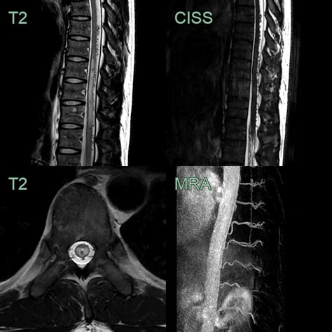 Spinal Davf Neuroradiology