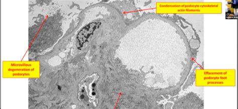 Iga Nephropathy Flashcards Quizlet