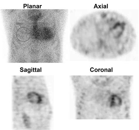 99mtc Bone Avid Tracer Cardiac Scintigraphy Role In Noninvasive