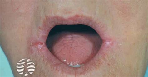 Angular Cheilitis Image