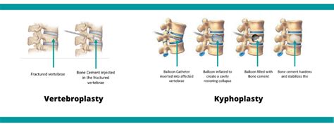 Vertebroplasty And Kyphoplasty Surgery In Mumbai Dr Bhavin Shial