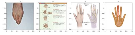 Early Detection Of Rheumatoid Arthritis Using Deep Learning Devpost