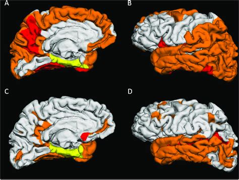 Brain Regions With Cortical Thickness Reduction Over The Progression Of Download Scientific