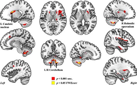 Grey Matter Volume Increase Over 6 Months In 132 Individuals Following Download Scientific