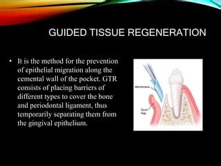 An Overview On Guided Tissue Regeneration Iqdw
