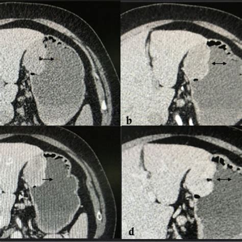 A Non Contrast Ct Scan Shows Well Defined Homogeneous Download